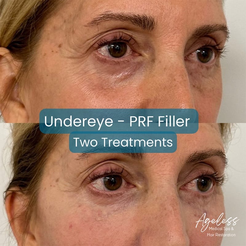 PRF EZ Gel Charleston | Natural Filler | Ageless Medical Spa
