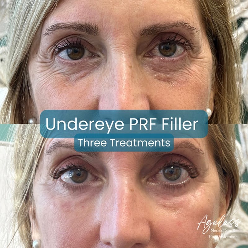 PRF EZ Gel Charleston | Natural Filler | Ageless Medical Spa