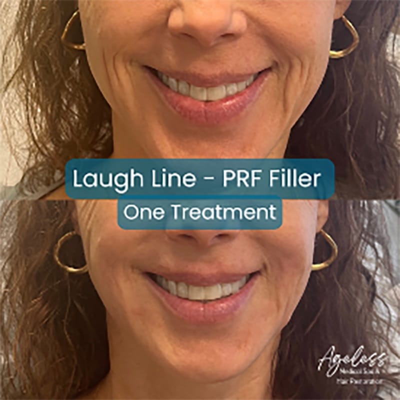 PRF EZ Gel Charleston | Natural Filler | Ageless Medical Spa